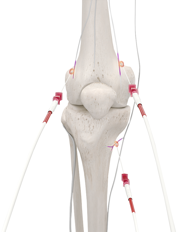 Genicular radiofrequency ablation | Interventional Spine