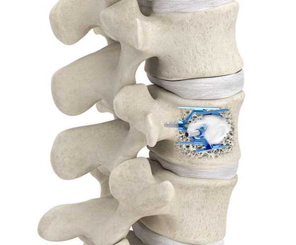 SpineJack system procedure | Interventional Spine SpineJack system procedure | Interventional Spine