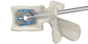 SpineJack system procedure | Interventional Spine