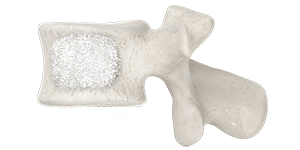 SpineJack system procedure | Interventional Spine