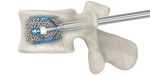 SpineJack system procedure | Interventional Spine