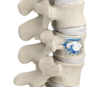 SpineJack system procedure | Interventional Spine